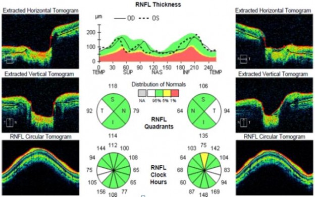 Zeiss HD OCT Retinal Scan – EyePlace