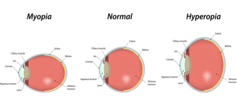 How eyes are changed when myopia progresses – EyePlace